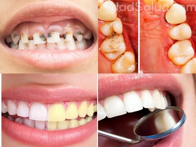Eliminar el sarro dental de forma segura y eficiente en tu hogar ...